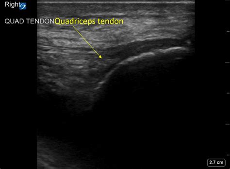 Quadriceps Tendon Ultrasound