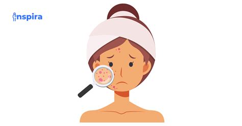 Proses Terjadinya Jerawat Inspira