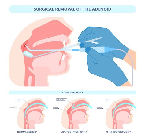 Adenoidectomy The Pros And Cons Of Removing Adenoids Credihealth