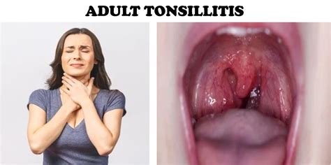 The Medical Science Behind Adult Tonsillitis By Dr Sharad Ent Medium