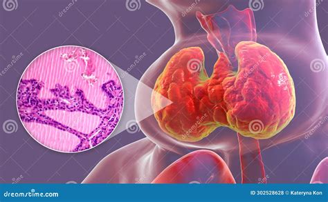 Toxic Goiter 3d Illustration And Micrograph 304782088