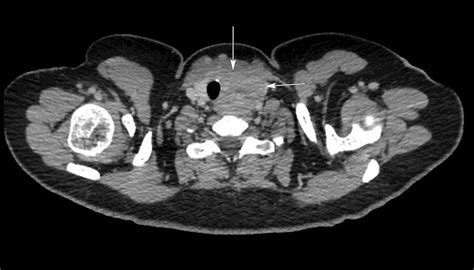 Axial Post Contrast Ct Thyroid Shows A Poorly Defined Soft Tissue Mass