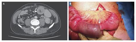 Enteroenteric Intussusception Medizzy