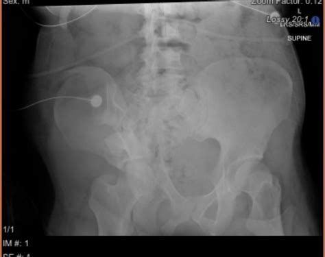 Fractured Right Acetabulum And Orif Of It Rxrayporn