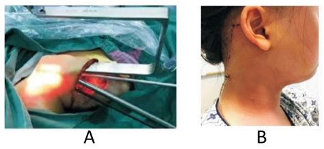 Video Transoral Robotic Total Thyroidectomy And Bilateral Central Regional Lymph Node