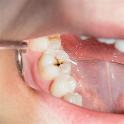 Best Tooth Decay Open 7 Days A Week Sitename