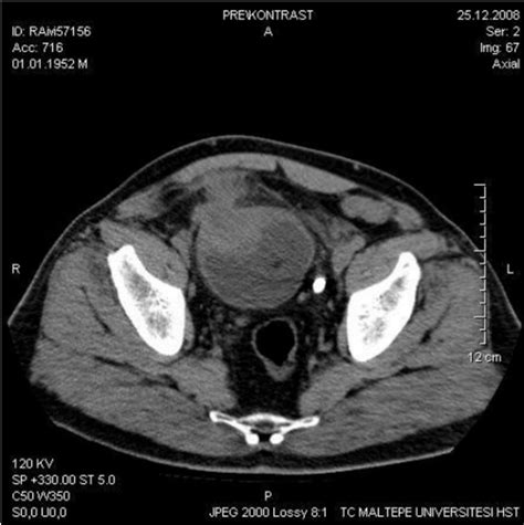 Ct Image Without Contrast Solid Lesion 60 55 Mm With Central