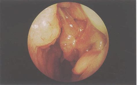 图2230 类固醇敏感性鼻息肉病 耳鼻咽喉科学彩色图谱