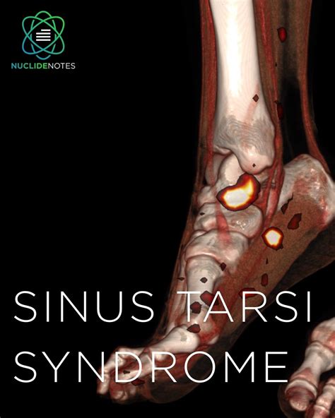 ☢️ Sinus Tarsi Syndrome ☢️ 24 Year Old Male With Chronic Right Foot