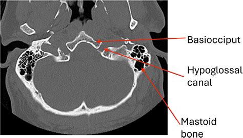 Anatomy And Imaging Of The Orbit And Skull Base Oral And