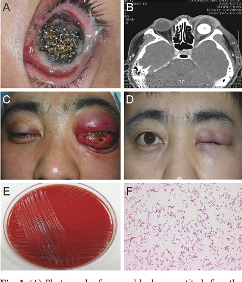 Ntm Atypical Keratitis Parasite