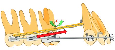 To Protract The Posterior Teeth Elastomeric Chain Was Connected From