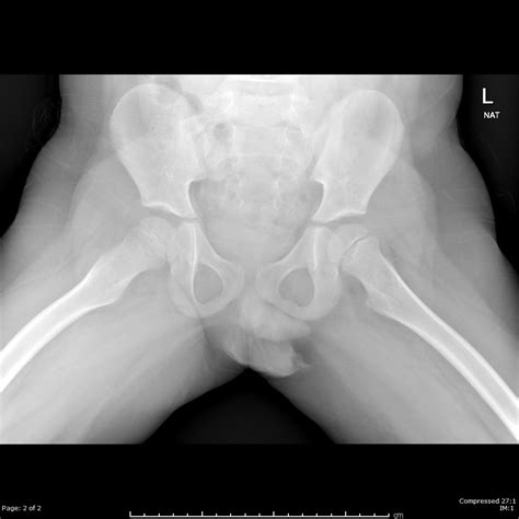 Normal Pelvis X Ray