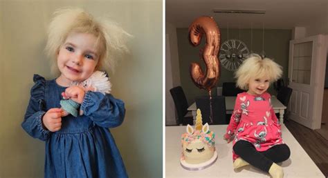 Girl Nicknamed ‘fluffy Is One Of Only 100 People With ‘uncombable Hair