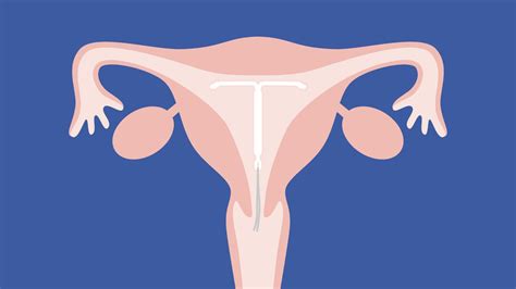 Iud And Ius Contraception A Comprehensive Guide Glamour Uk