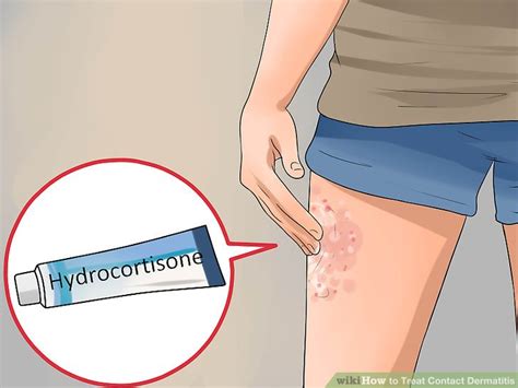 How To Treat Contact Dermatitis 15 Steps With Pictures
