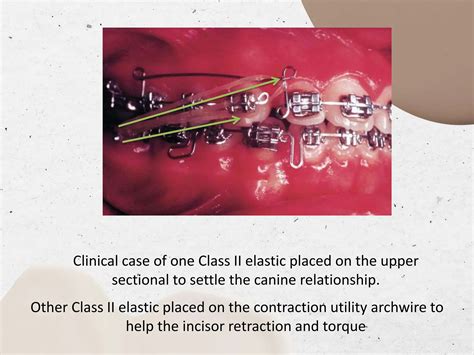 Intraoral Elastics In Orthodontics Pptx