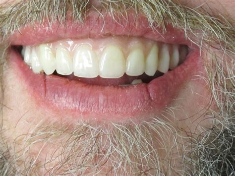 Tooth Borne Palate Less Over Dentures Utilizing Ceka Attachments And