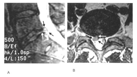 Imaging Of Lumbar Spondylosis Pptx