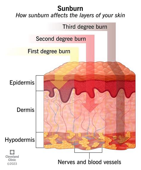 Are Sunburns Bad For You At Katheryn Wingfield Blog