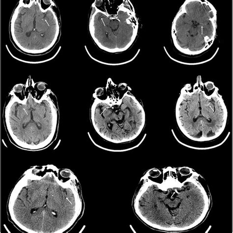 Ct Head Images Showing Hyperdense Vessel Sign In Dtas Patients Download Scientific Diagram