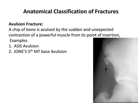 Classification Of Fractures And Compound Fracture Managment Pptx