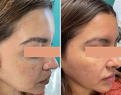 Hyperpigmentation Skin Lab Medspa