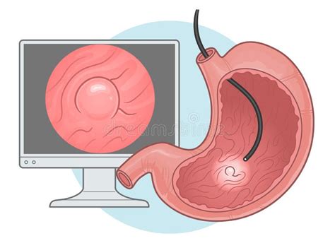 Gastroscopy Procedure Stock Illustrations 253 Gastroscopy Procedure