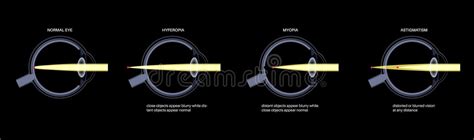 Hyperopia Astigmatism Stock Illustrations 706 Hyperopia Astigmatism