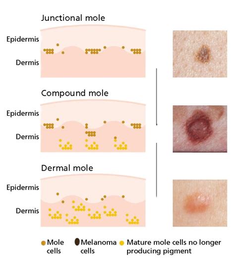 Looking After Your Moles Leeds Teaching Hospitals Nhs Trust