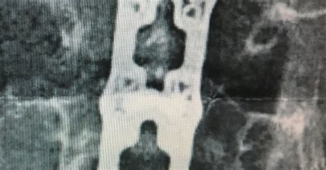 Thoracic Laminectomy Non Moto Motocross Forums Message Boards Vital Mx