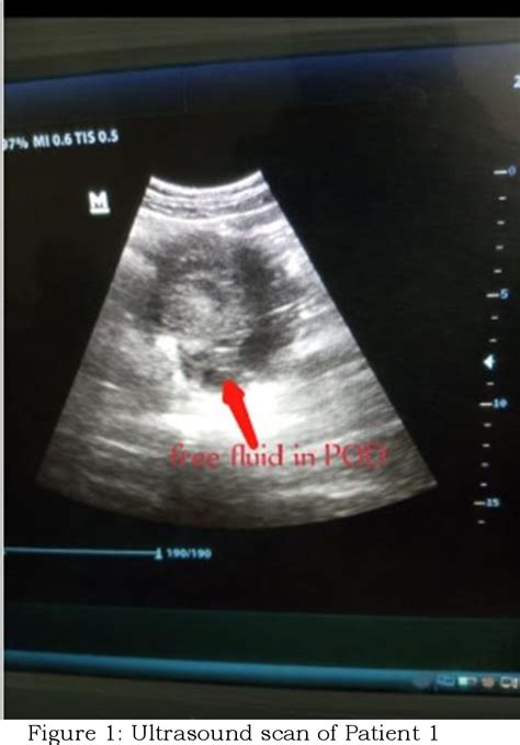 Figure 1 From Efficacy Of Transabdominal Pelvic Ultrasound In The