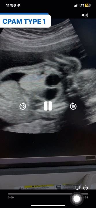 Video Shennel Agyemang On Linkedin The Right Lobe Of The Lung Is