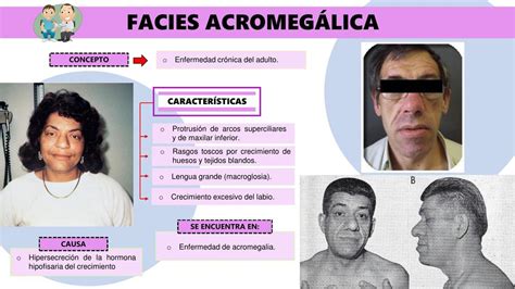 Facies Parkinsoniana