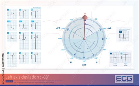 When The Electrical Axis Of The Electrocardiogram Is Severely Left