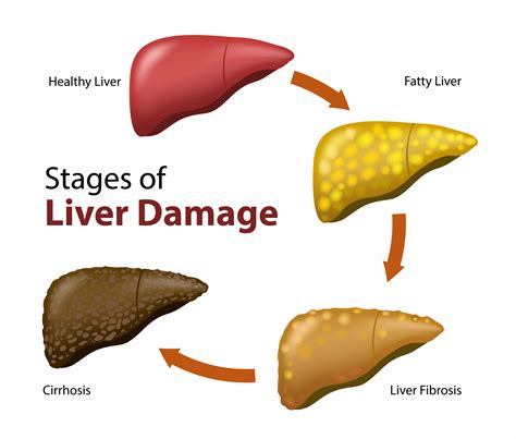 Causes Of Fatty Liver And Its Treatment Sanjana Shenoy