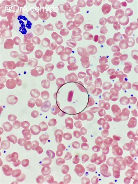 Hemoglobin C Crystals