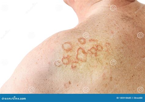 Atopic Dermatitis Ad Also Known As Atopic Eczema Is A Type Of Skin Inflammation Dermatitis On