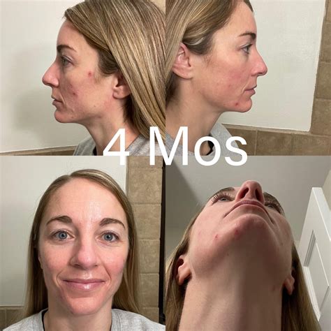 6 Month Progression Raccutane