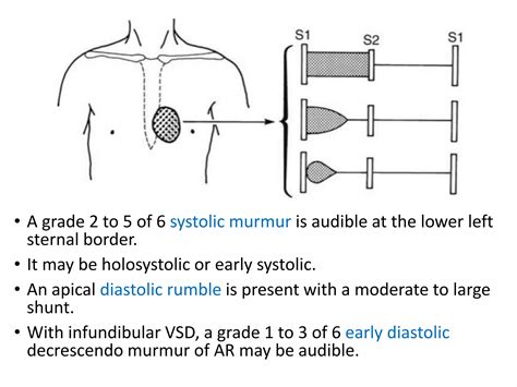 Ventricular Septal Defect Pptx
