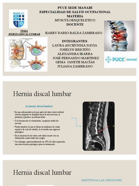 Hernia Discal Lumbar Pdf Dolor Lumbar Medicina