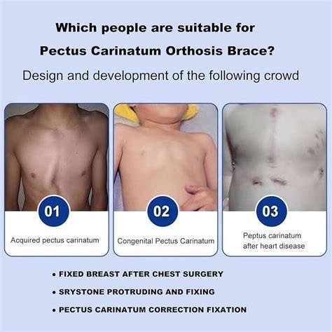 Pectus Carinatum Infantil Anomalías Torácicas Pediatría Integral