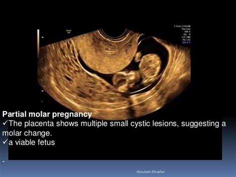 Placenta Previa First Trimester