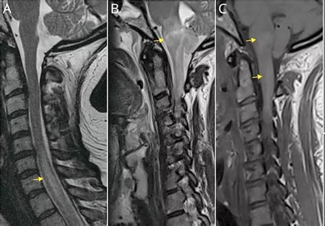 Hemorrhagic Myelitis After The Sars Cov 2 Infection