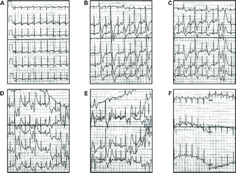 electrocardiographic recordings during treadmill testing in the proband