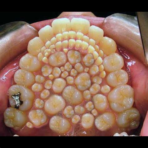 Is This Art Now [trigger] R Trypophilia