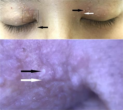 Milia Eyelid
