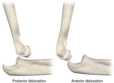 Management Of Common Dislocations Clinical Tree