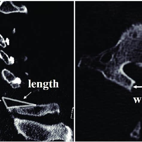 The Extent Of C7 Dome Like Laminectomy Was Measured In Three Parameters