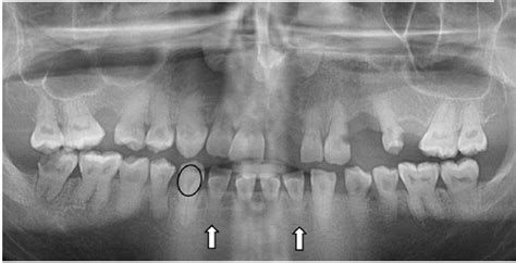 Clinical Photograph Showing The Missing Teeth In The Upper Jaw On Download Scientific Diagram